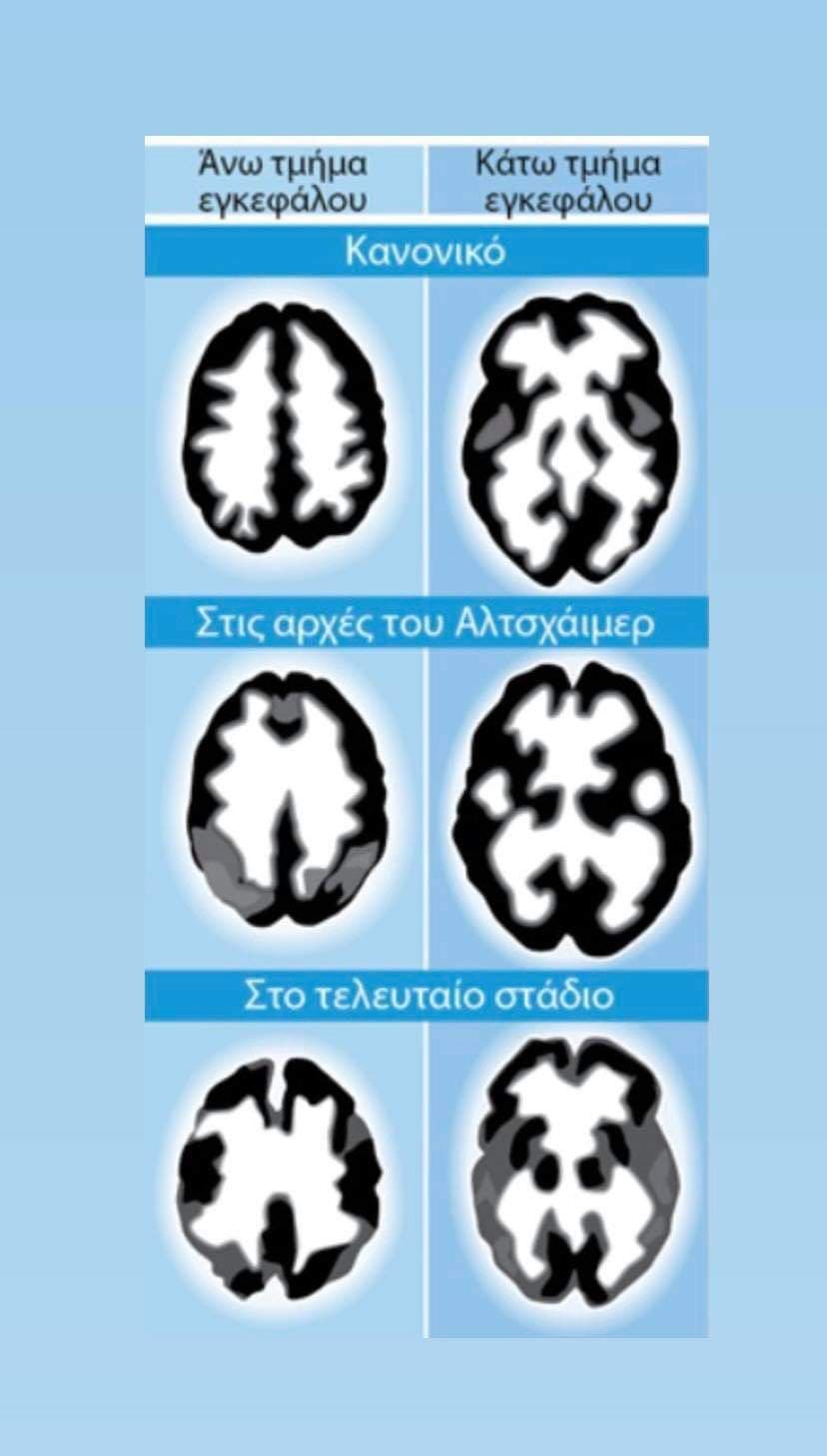 Άνοια: Στάδια, Συμπτώματα, Θεραπεία και προσδόκιμο ζωής - Truemed.gr