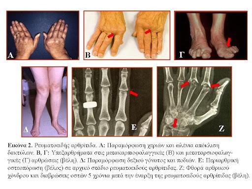 ΡΕΥΜΑΤΟΕΙΔΗΣ ΑΡΘΡΙΤΙΔΑ: Όλα όσα πρέπει να γνωρίζετε - Truemed.gr
