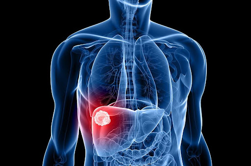 Καρκίνος του Ήπατος: Συμπτώματα – Αντιμετώπιση - Truemed.gr