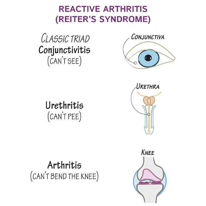 Reiter syndrome - Truemed.gr